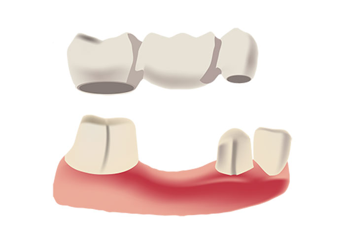 Restorative Dentistry Services at Focal Dental in UBC Vancouver